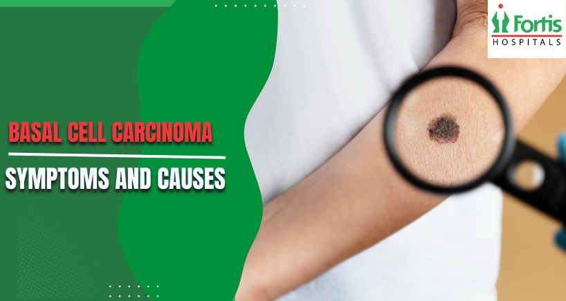 Basal Cell Carcinoma Key Symptoms And Causes 0847